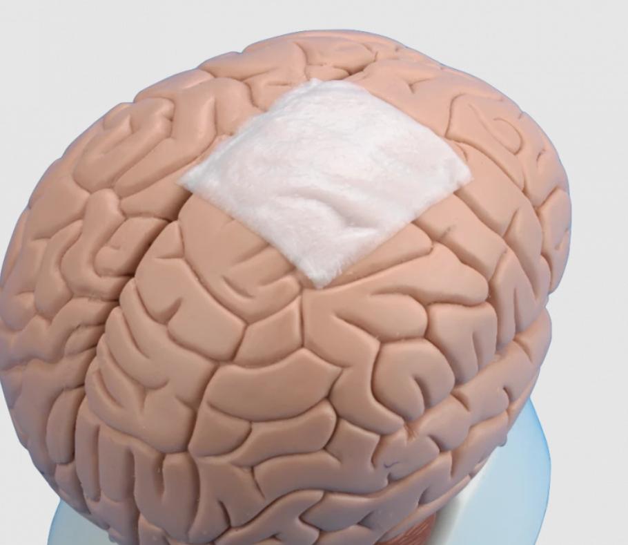 Parche Dura Madre Suturable Kanger ® | | Craneo | Catálogo